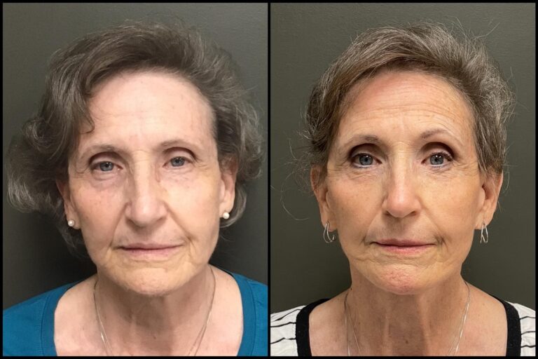 Mini Facelift Before & After Photos - Freed Plastic Surgery