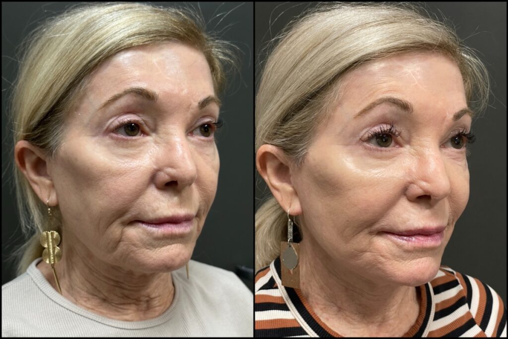 Mini Facelift Before & After Photos - Freed Plastic Surgery