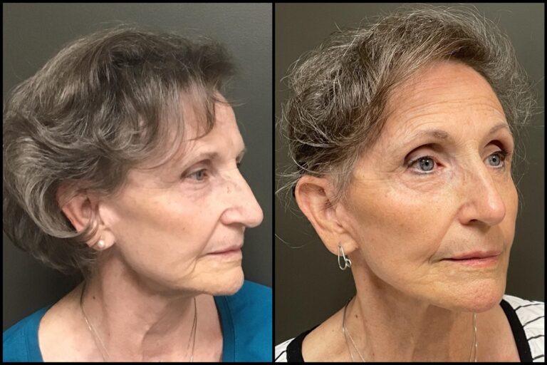 Mini Facelift Before & After Photos - Freed Plastic Surgery