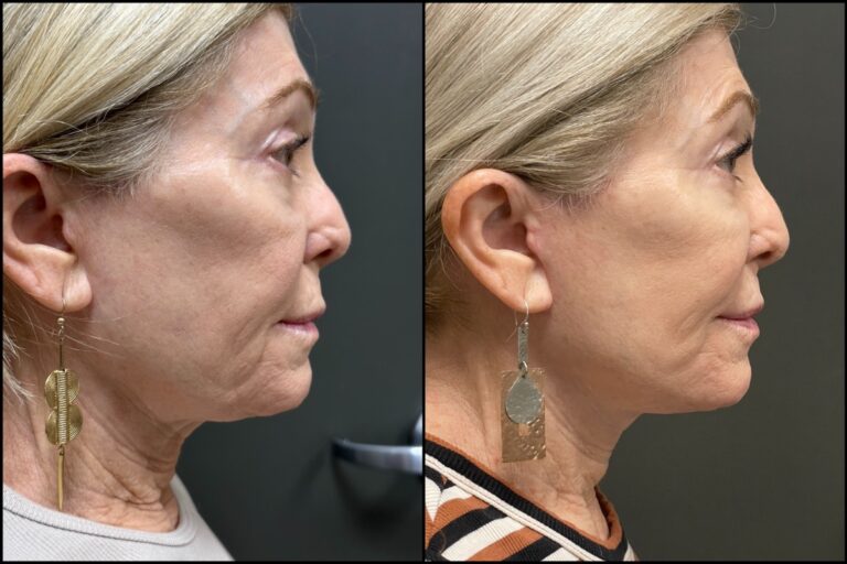 Mini Facelift Before & After Photos - Freed Plastic Surgery