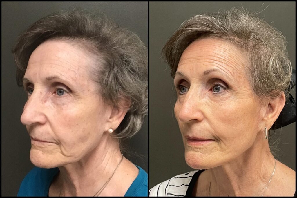 Mini Facelift Before & After Photos - Freed Plastic Surgery